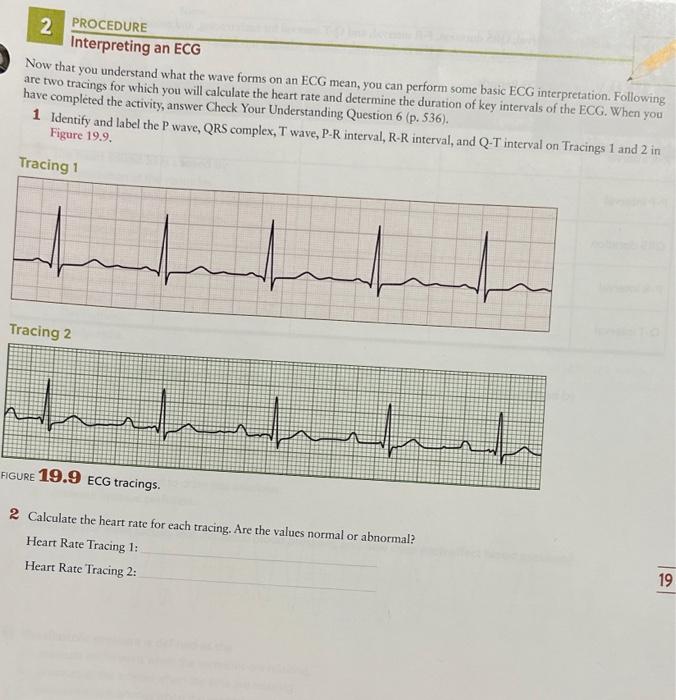 Solved Now that you understand what the wave forms on an ECG | Chegg.com