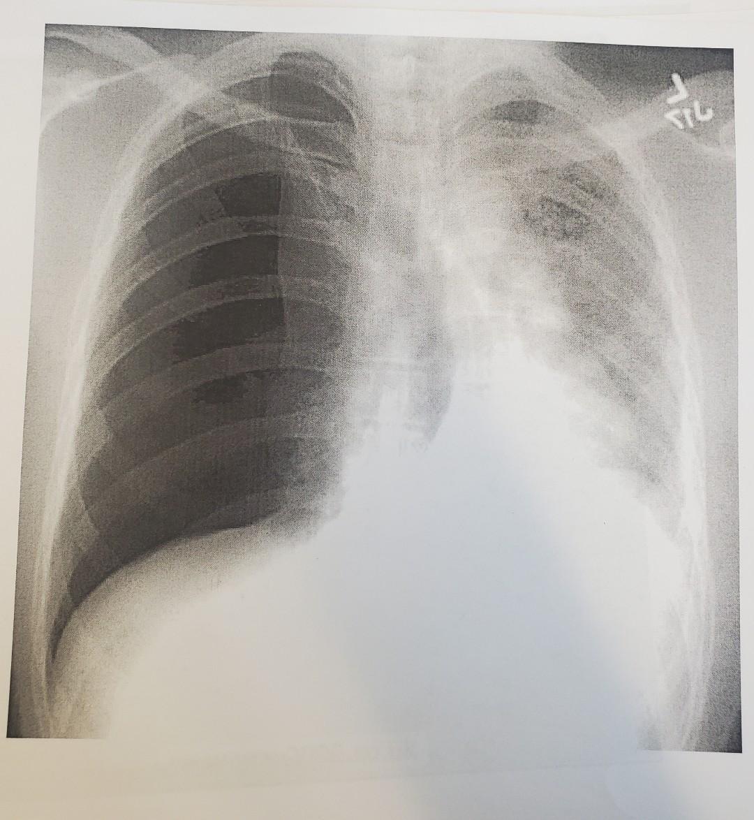 Solved 4-interpret ﻿﻿this ﻿﻿CXR ﻿﻿and ﻿﻿explain ﻿﻿reasoning | Chegg.com