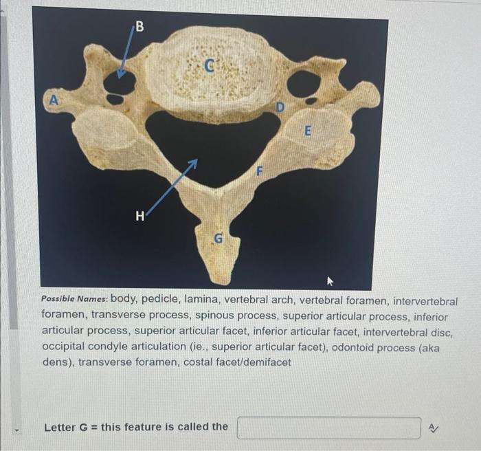 Solved Possible Names: body, pedicle, lamina, vertebral | Chegg.com