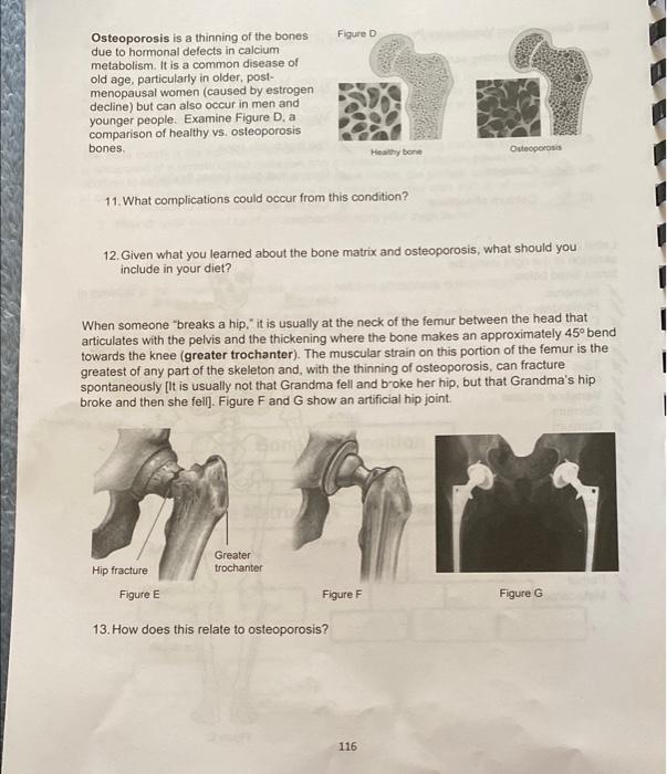 Solved Figure D Osteoporosis is a thinning of the bones due | Chegg.com