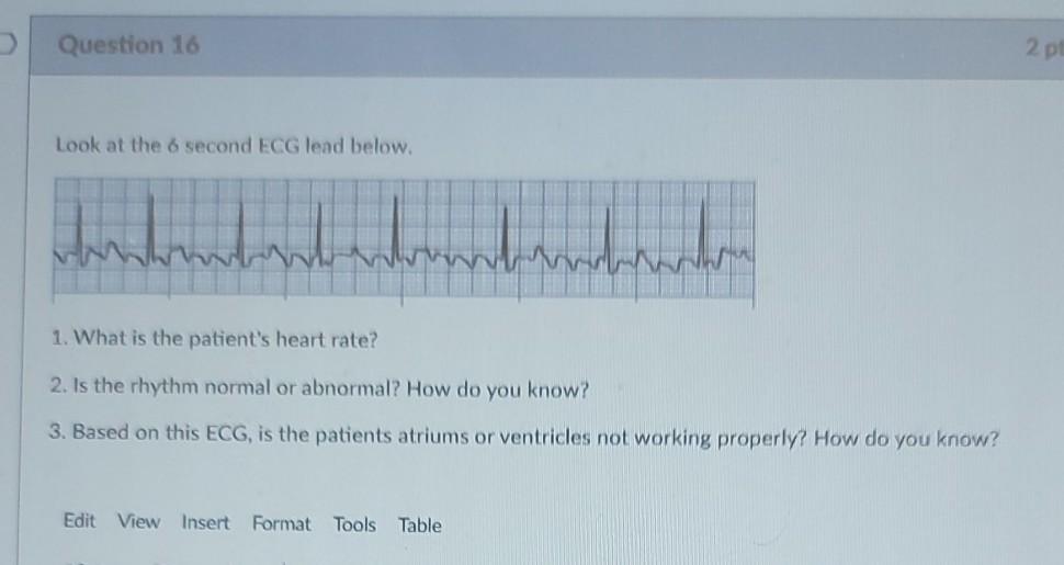 Solved Question 16 2 pl Look at the 6 second ECG lead below. | Chegg.com