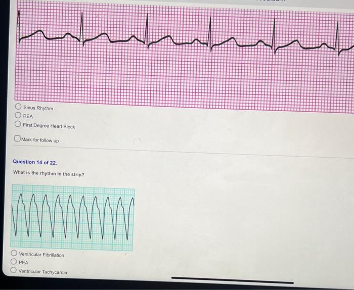 Solved What is the rhythm in the strip? Ventricular | Chegg.com