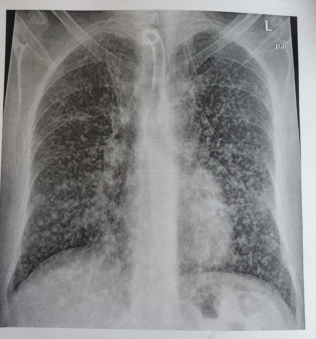 Solved 14 ﻿interpret This Cxr And Explain Reasoning Behind