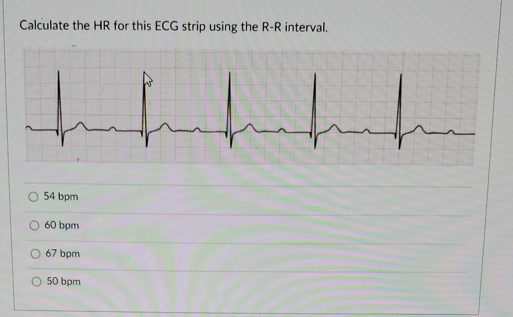 Myocardial Infarction Ecg Strip