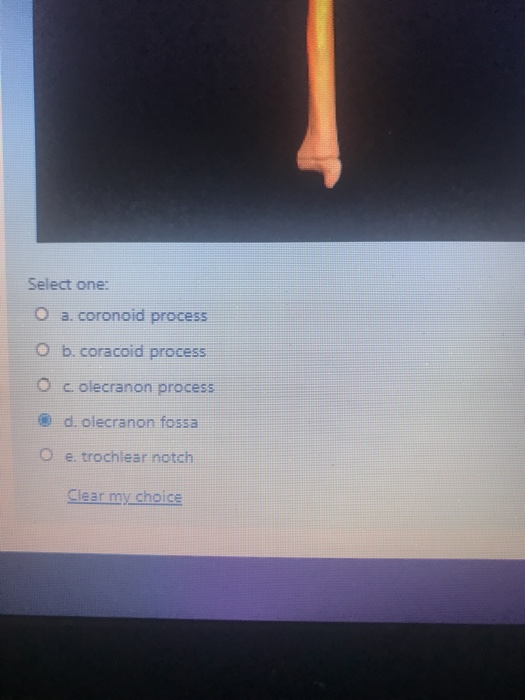 Solved Select one: O a. coronoid process O b. coracoid | Chegg.com