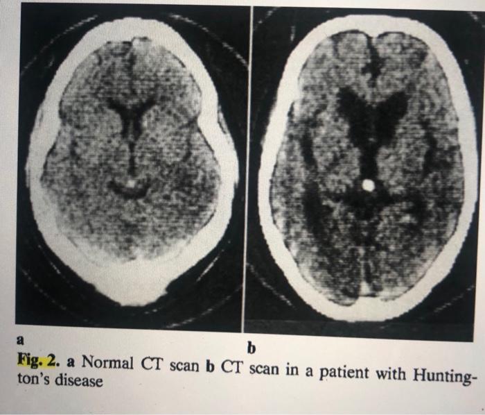 Solved a b Fig. 2. a Normal CT scan b CT scan in a patient | Chegg.com