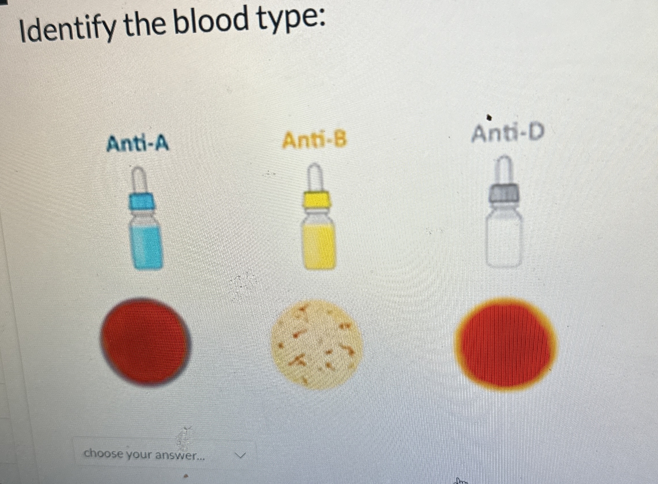 Solved Identify the blood type:Anti-AAnti-BAnti-Dchoose your | Chegg.com