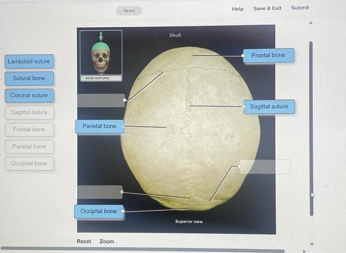 Solved Lambdoid suture Sutural bone Coronal suture Sagittal | Chegg.com