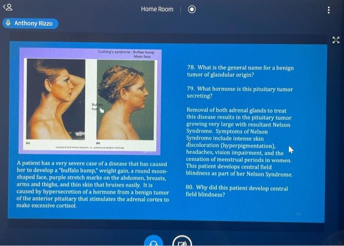 Solved Home Room . Anthony Rizzo Cushing's syndrome Buffalo | Chegg.com