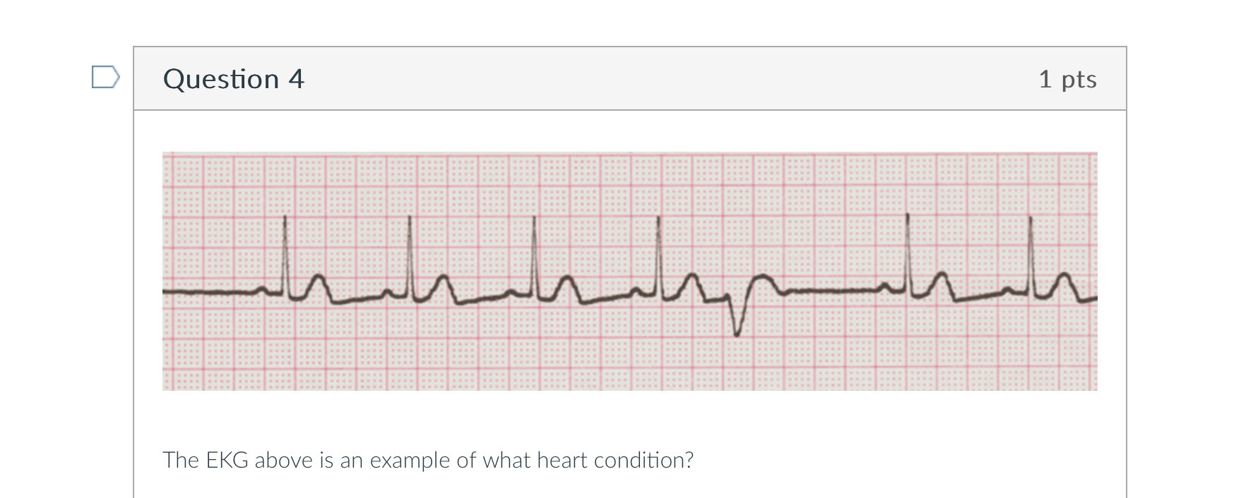 Solved Question 41 ﻿ptsThe EKG above is an example of what | Chegg.com