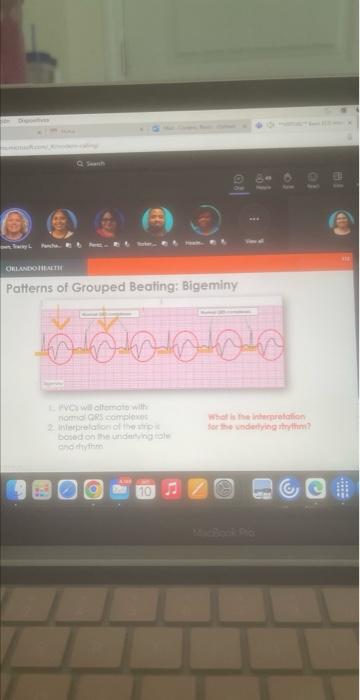 Solved Patterns of Grouped Beating: Bigeminy | Chegg.com