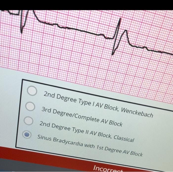 Solved Junctional Tachycardia Supraventricular Tachycardia | Chegg.com