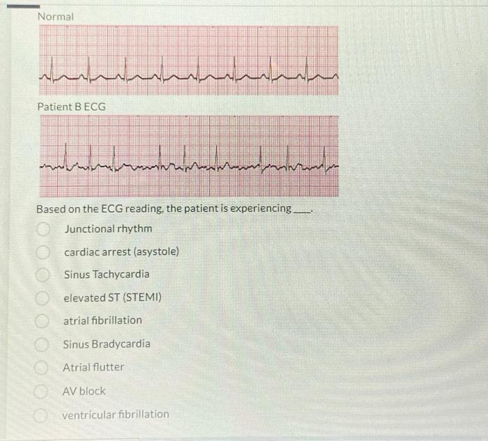 Solved Normal Patient BECG Based on the ECG reading, the | Chegg.com