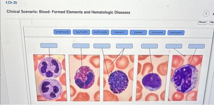 Solved Clinical Scenario: Blood- Formed Elements and | Chegg.com