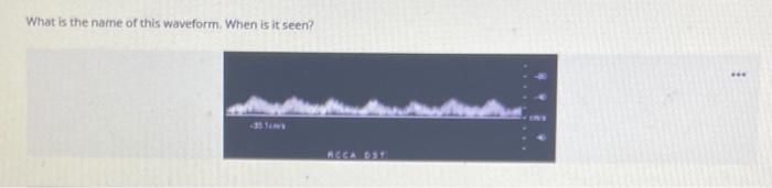 This internal carotid artery (ICA) spectral waveform | Chegg.com