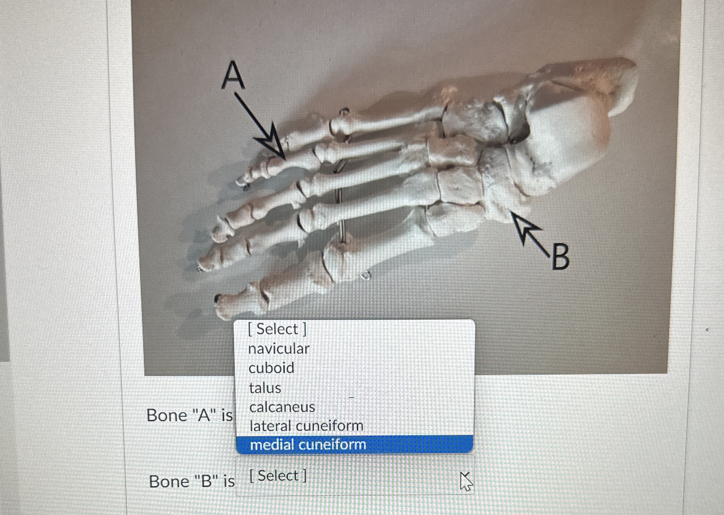 Solved Bone " B " ﻿is[Select] | Chegg.com