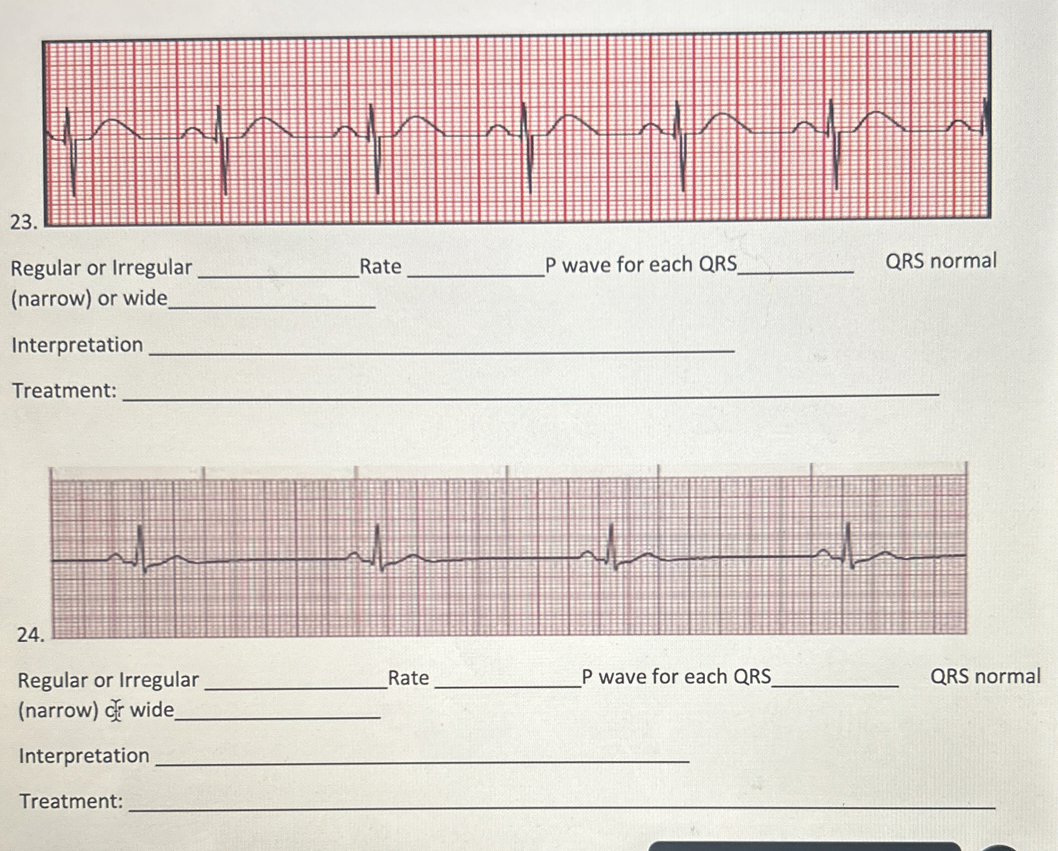 Solved Regular or IrregulatlateP wave for each QRSQRS normal | Chegg.com