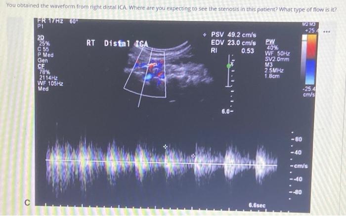 You obtained the waveform from right distal ICA. | Chegg.com