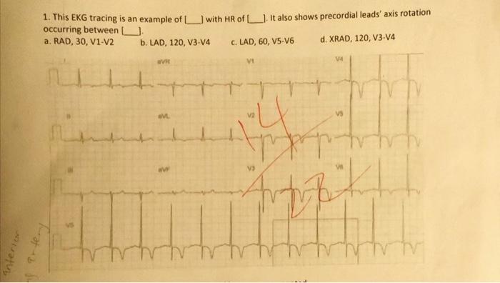 Solved 1. This EKG tracing is an example of __ with HR of. | Chegg.com
