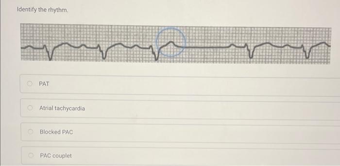 Paroxysmal Atrial Tachycardia Pat