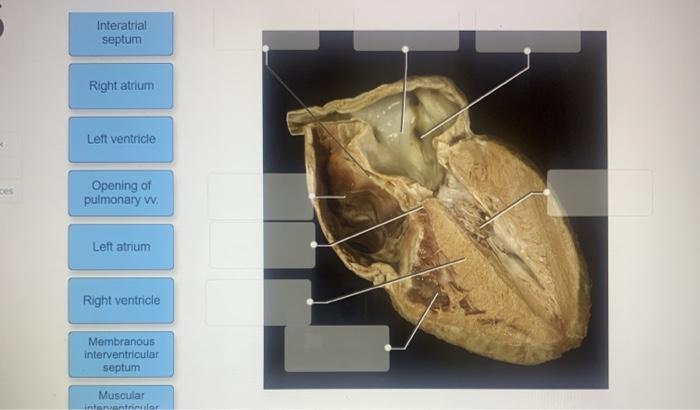 Solved Interatrial septum Right atrium Left ventricle | Chegg.com