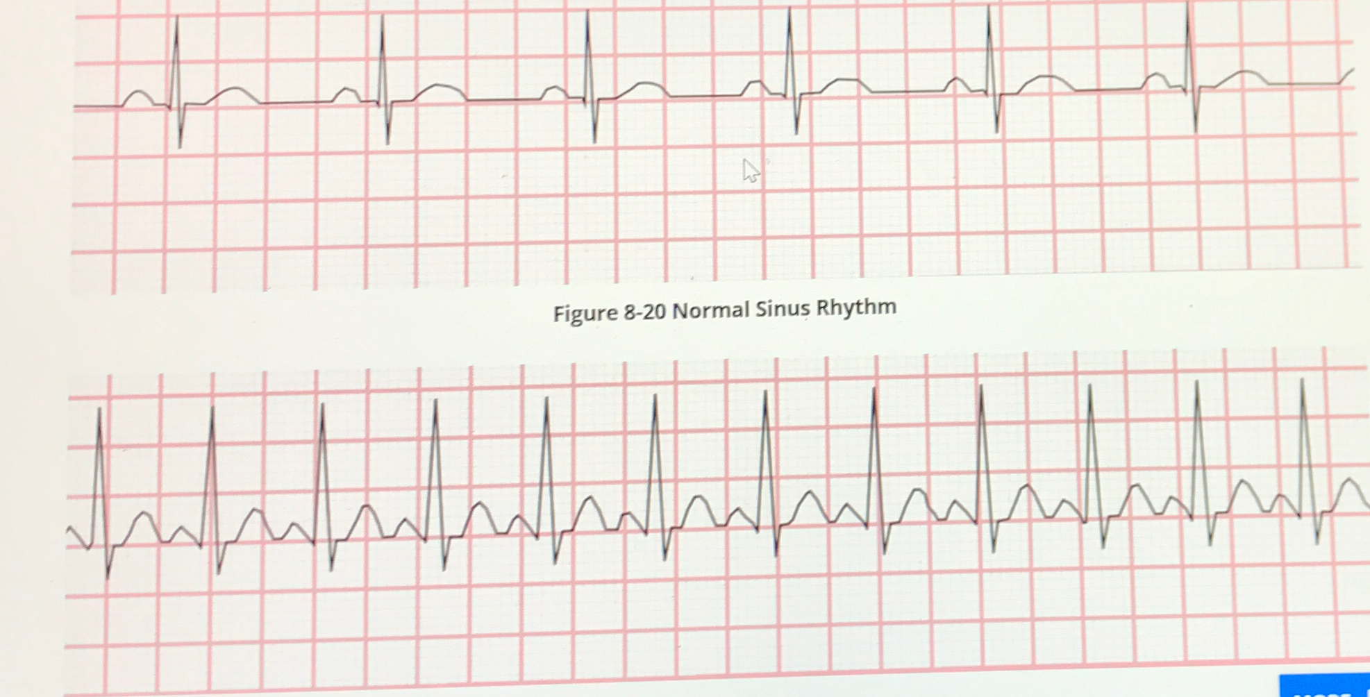 Solved Figure 8-20 ﻿Normal Sinus RhythmHow does the rate of | Chegg.com