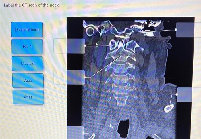 Solved Label the CT scan of the neck. Occipital bone Rib 1 | Chegg.com