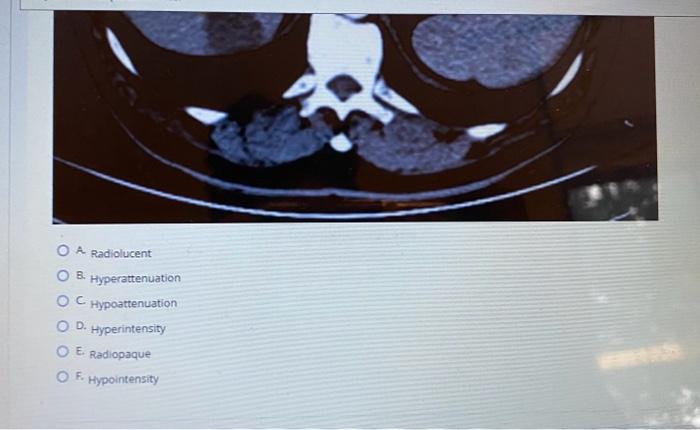 Solved B. Hyperattenuation C. Hypoattenuation D. | Chegg.com