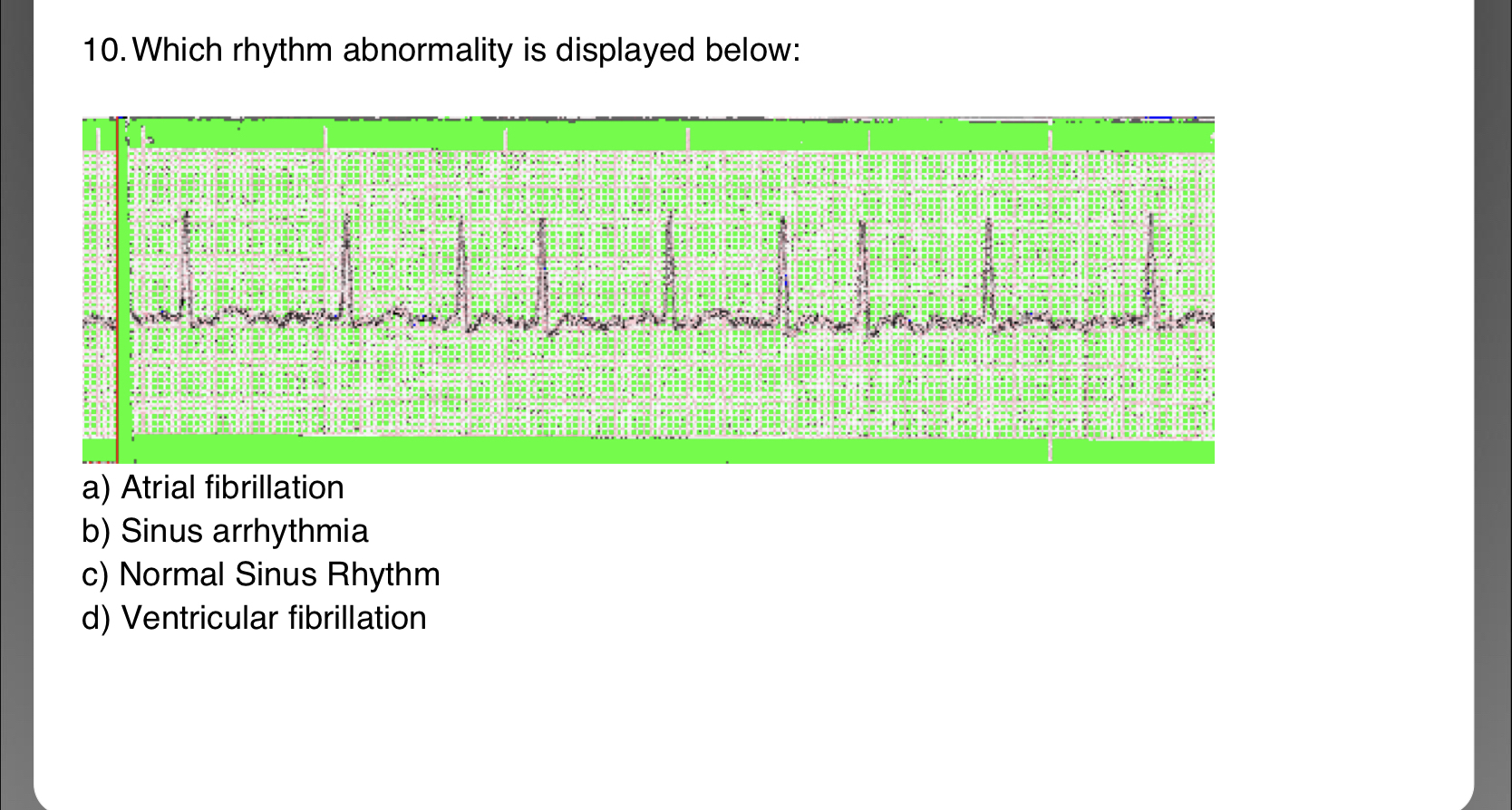 Solved Which rhythm abnormality is displayed below:a) | Chegg.com