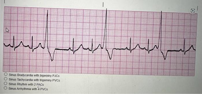 Solved Sinus Rhythm with 2 PACs Sinus Arshythmia with 4 PVCs | Chegg.com