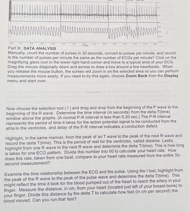 Solved Refer to your textbook for a normal EKG tracing | Chegg.com