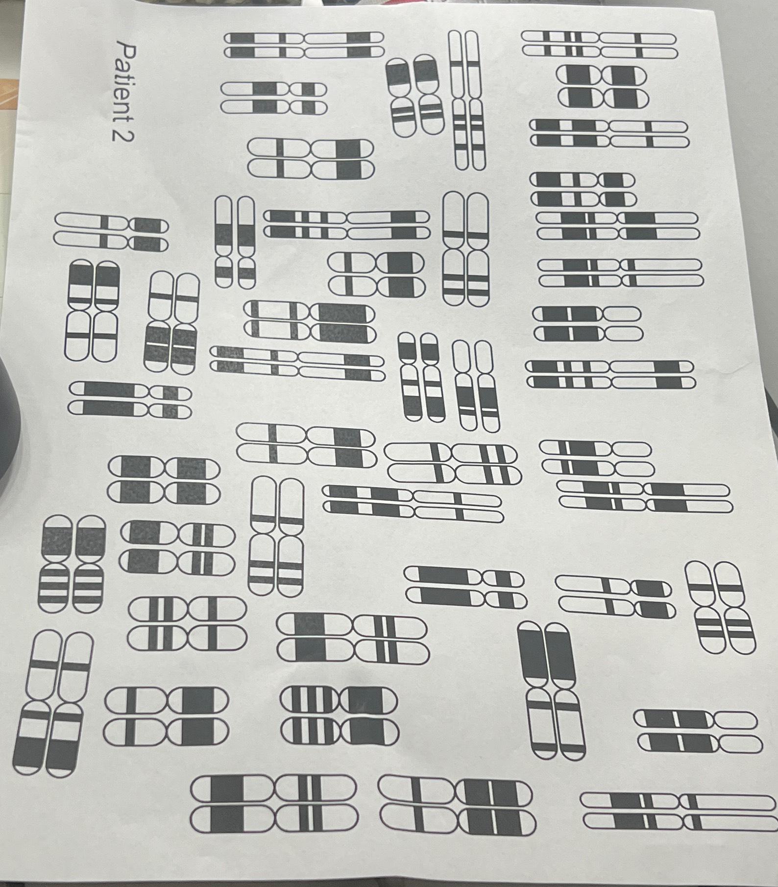 Solved Extra Chromosome 13: Patau syndromeExtra Chromosome | Chegg.com