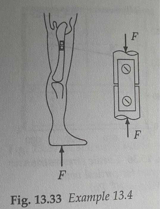 Solved Problem 13.7 Consider a fixation device consisting of | Chegg.com