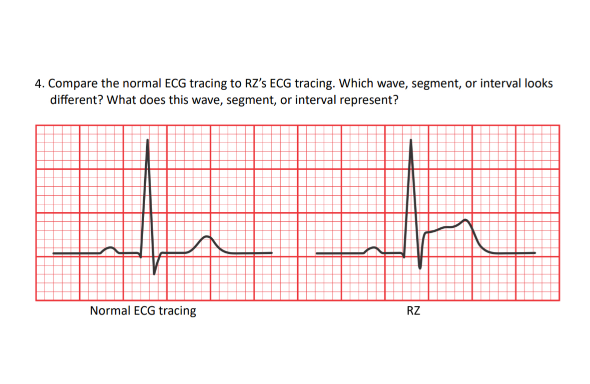 Solved Compare the normal ECG tracing to RZ's ECG tracing. | Chegg.com