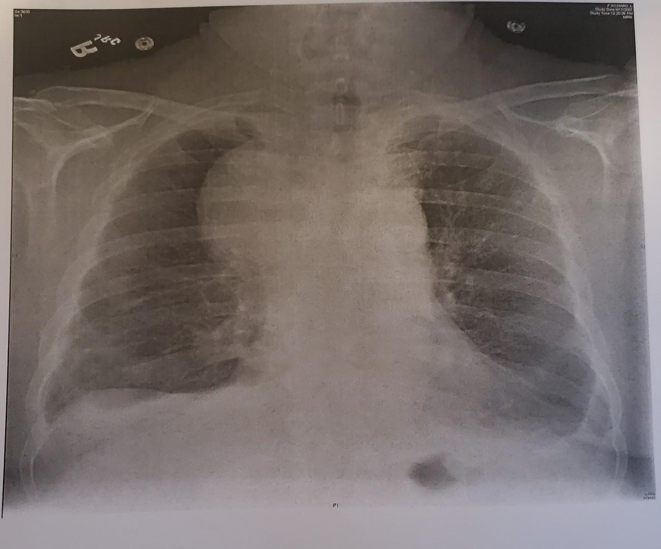 1- ﻿﻿interpret ﻿this ﻿CXR ﻿and ﻿explain ﻿reasoning | Chegg.com