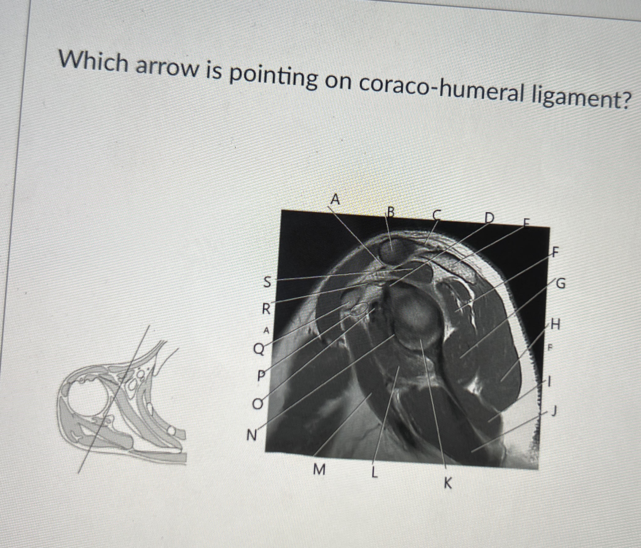 Solved Which arrow is pointing on coraco-humeral ligament? | Chegg.com