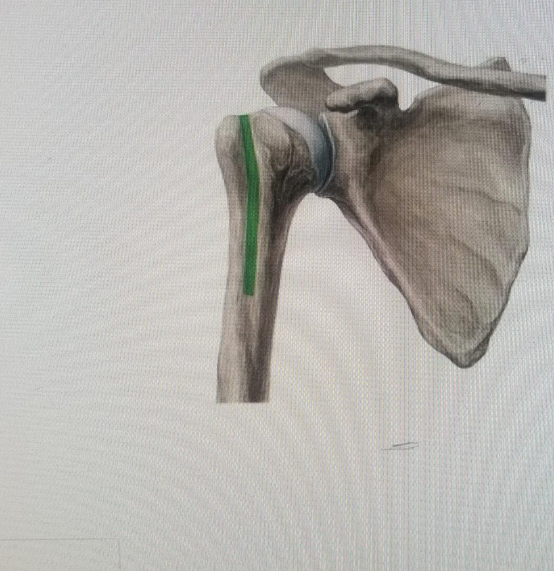 Solved Which muscle inserts on the structure highlighted in | Chegg.com