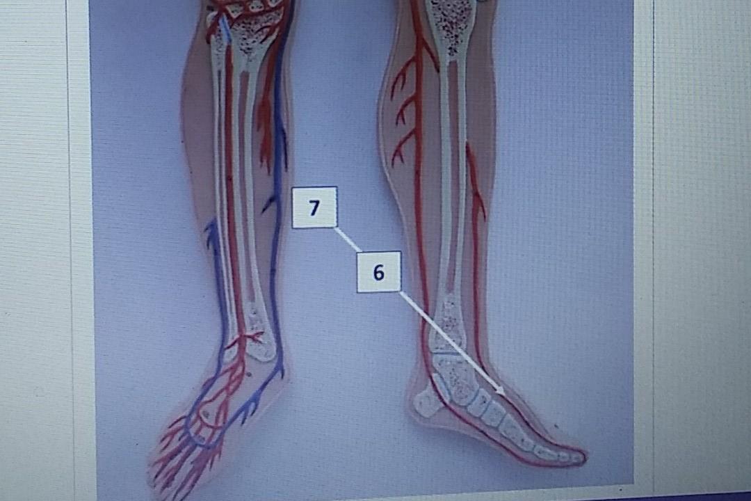 Solved 2 Name the pinned structure Linea.alba Linea aspera | Chegg.com