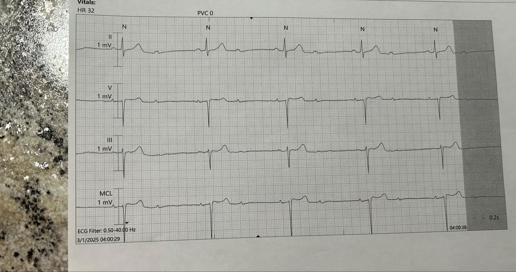 Solved Answer for strips 1-5. ﻿What is ﻿the PR ﻿interval? | Chegg.com