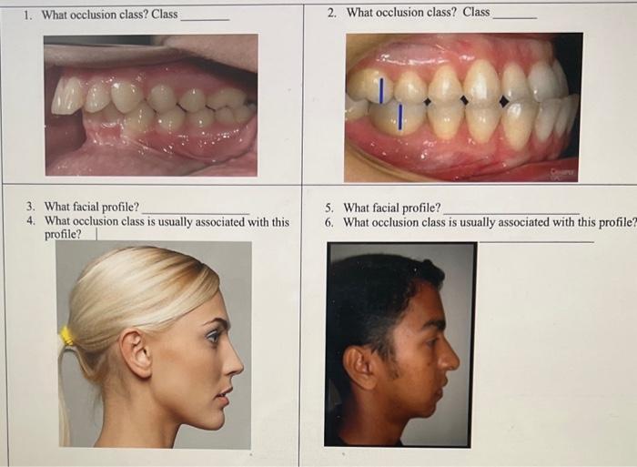 1. What occlusion class? Class 2. What occlusion | Chegg.com