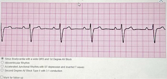 Solved Sinus Bradycardia with a wide QRS and 1st Degree AV | Chegg.com