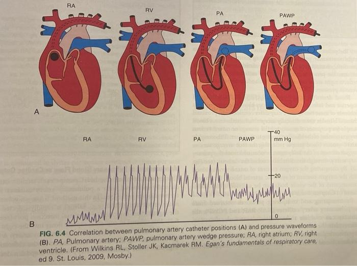 Pulmonary Artery Catheter Waveforms