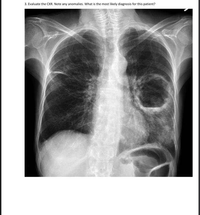 Solved 3. Evaluate the CXR. Note any anomalies. What is the | Chegg.com