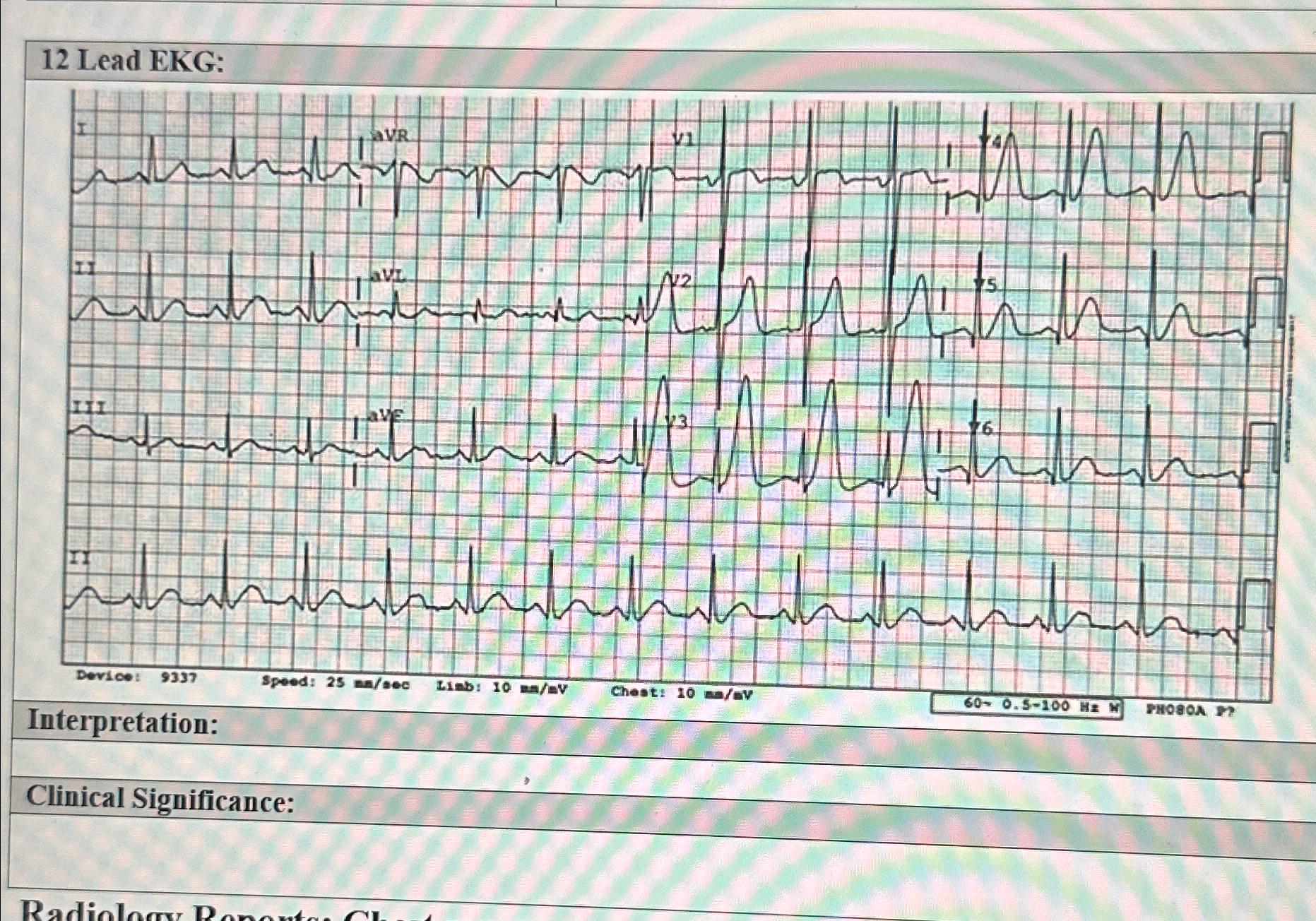 Solved 12 ﻿Lead EKG:Interpretation:Clinical | Chegg.com