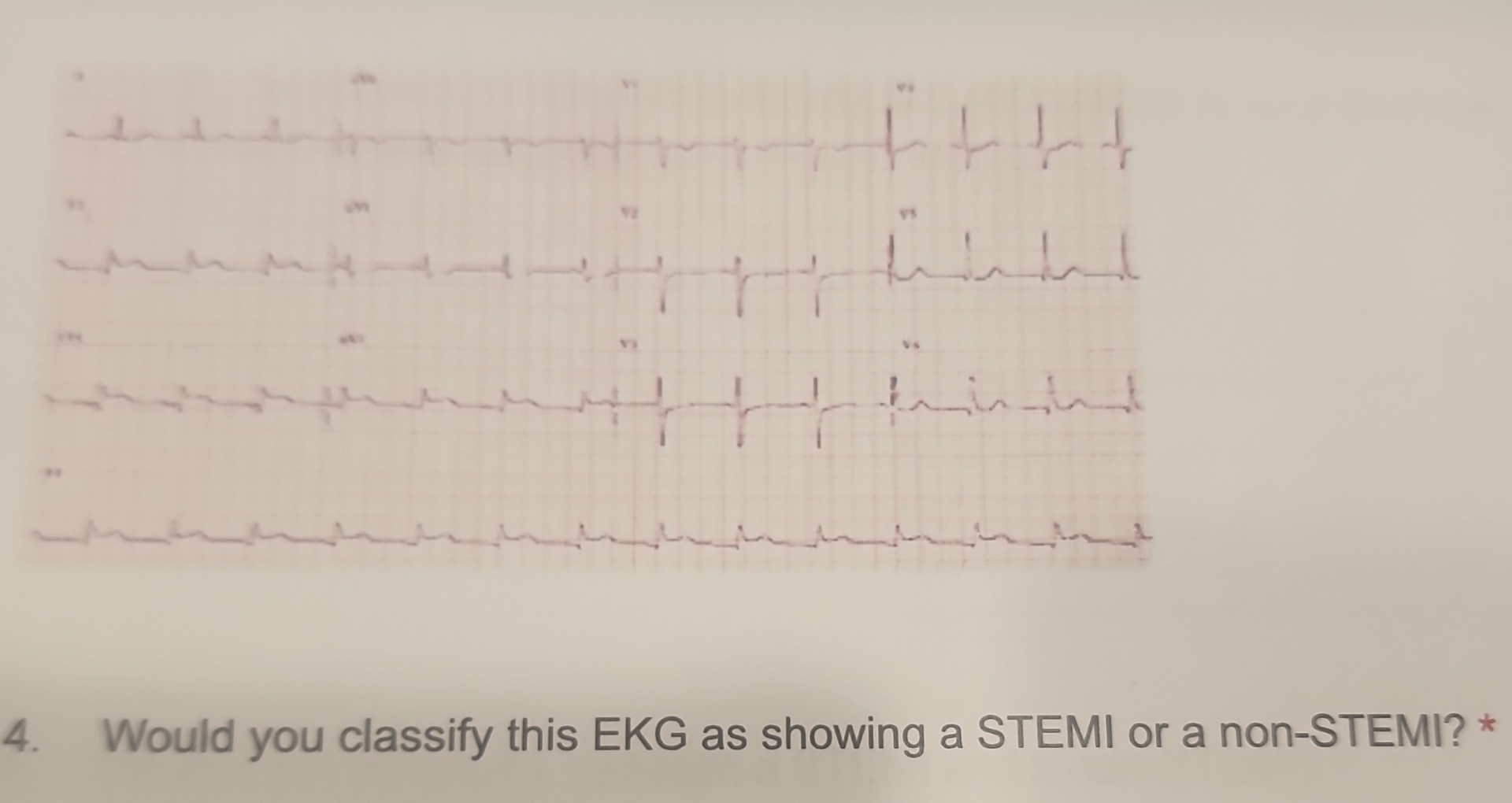 Solved Would you classify this EKG as showing a STEMI or a | Chegg.com