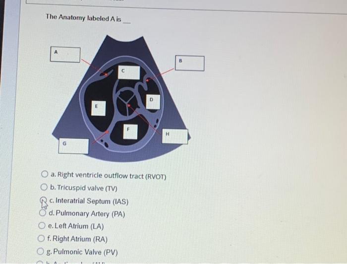 Solved The Anatomy labeled A is a. Right ventricle outflow | Chegg.com