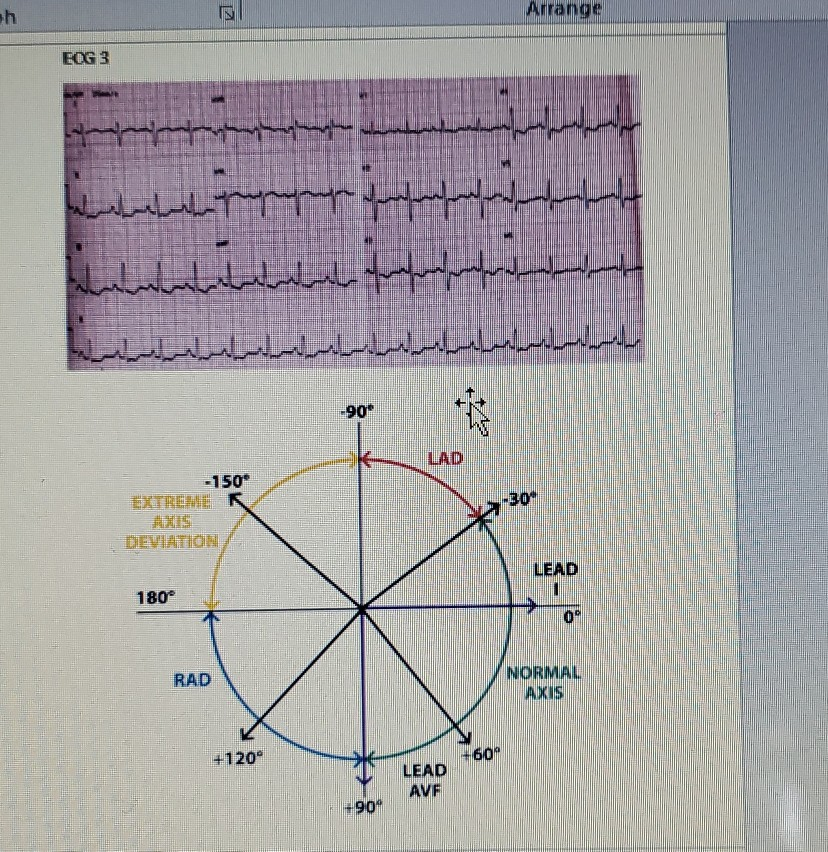 D. Determine the Mean Electrical Axis represented by | Chegg.com