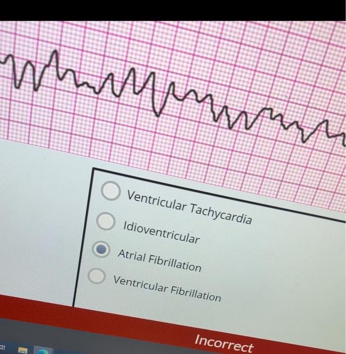 Sinus Arrhythmia Sinus Rhythm with PVC Sinus Rhythm | Chegg.com