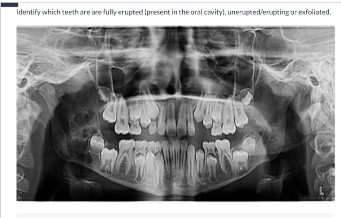 Identify which teeth are are fully erupted (present | Chegg.com