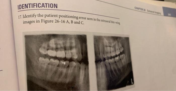 17. Identify the patient positioning error seen in | Chegg.com